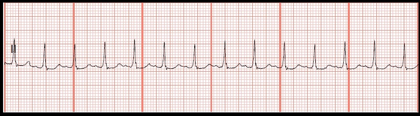 Practice EKG Rhythm Strips 196
