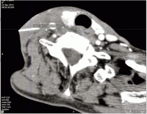 VIETNAMESE MEDIC ULTRASOUND: CASE 313: FISH BONE APPEARING in NECK, Dr ...