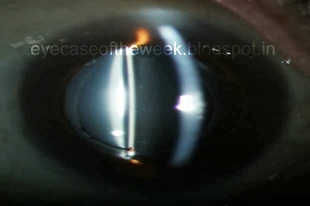 Eye Case of the Week: A Curious Case of Late Onset Vision Loss after ...