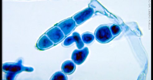 Qu'est-ce que la teigne?