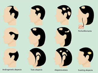 New England Associates®: The Different Types of Alopecia