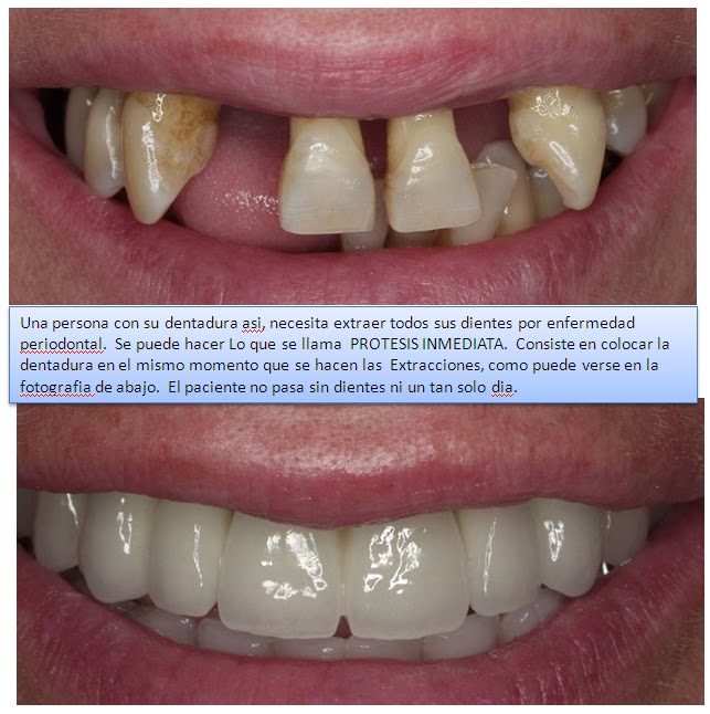 Protesis Dental Inmediata