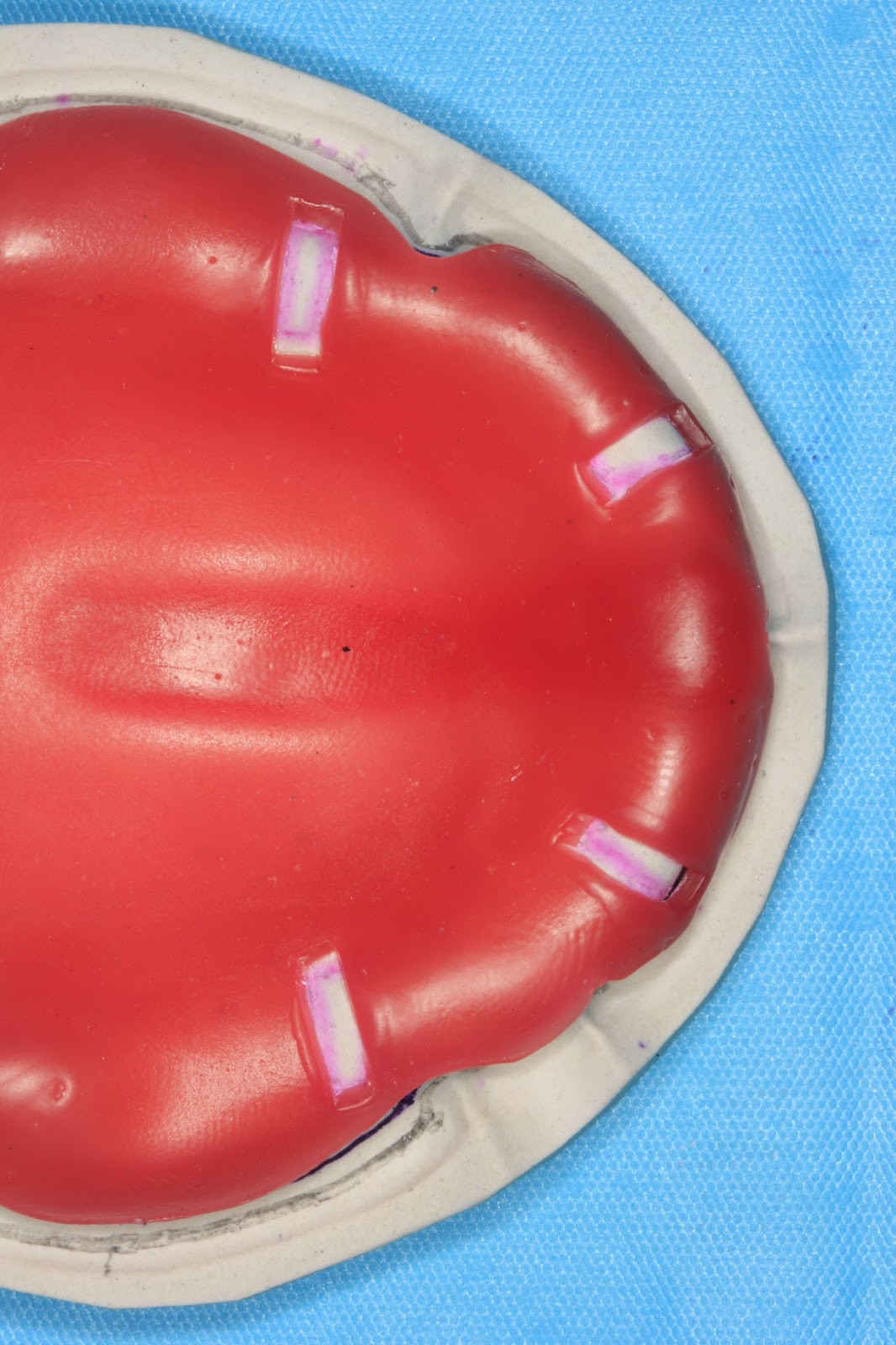 Understanding Prosthodontics - Tagore Dental College & Hospital-By ...