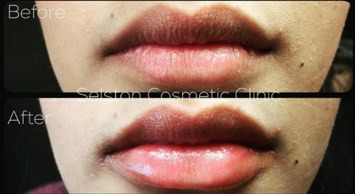 Selston Cosmetic Clinic: Enhance Your Lips With Dermal Filler ...