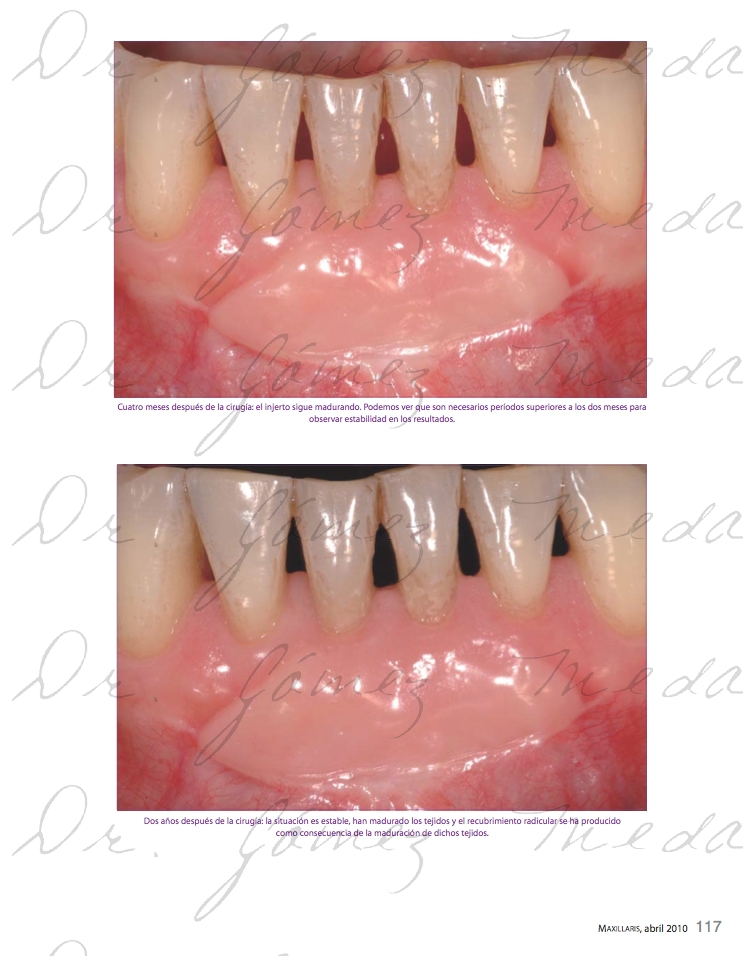 Dr.Meda: Injerto Epitelial Libre: Control de la Estabilidad a Largo ...
