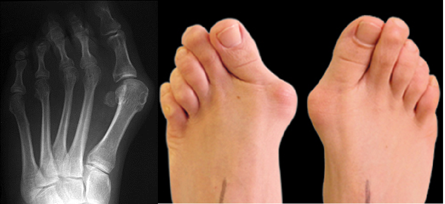 Blog de ortopedia Inse: Hallux Valgus (Juanete)