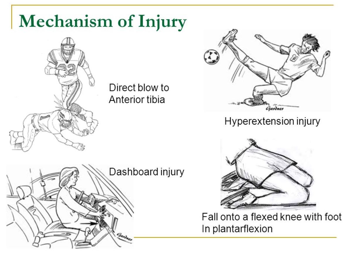 4 common PCL injury mechanisms and what to do and not to do about it?