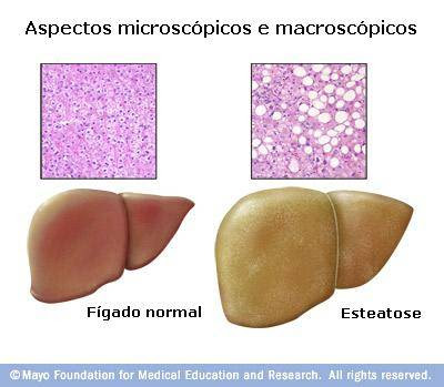 Atlas virtual de histologia e patologia: [CC #7]: ESTEATOSE HEPÁTICA