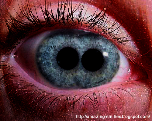 Two Pupils In One Eye