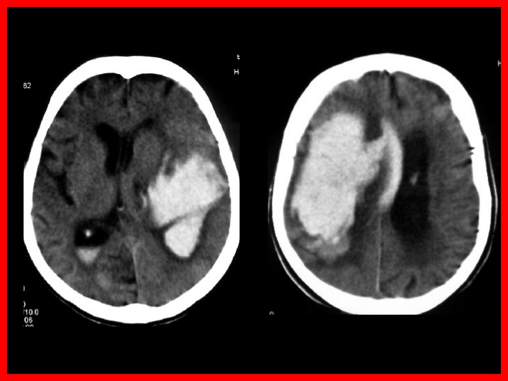 Accidente cerebrovascular hemorragico