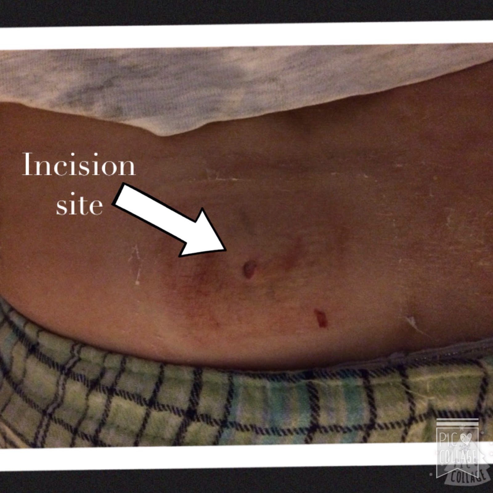 Olivia's Lymphoma Journey: Bone Marrow Biopsy 10-21-15