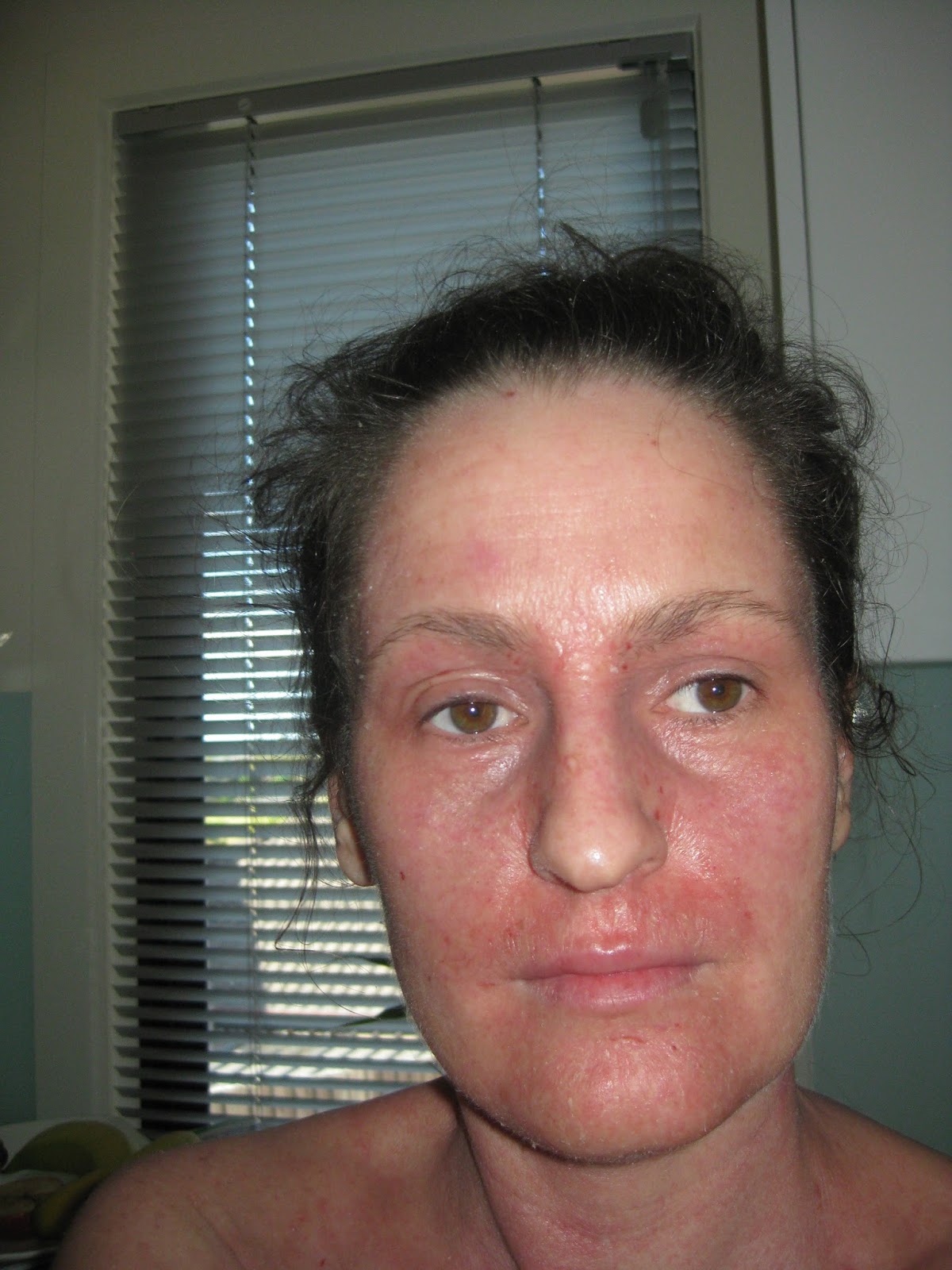 Topical Steroid Withdrawal Journey-Healing Eczema and Red Skin Syndrome