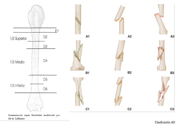 El Blog de Isa y Juan: Fractura de la diáfisis del húmero