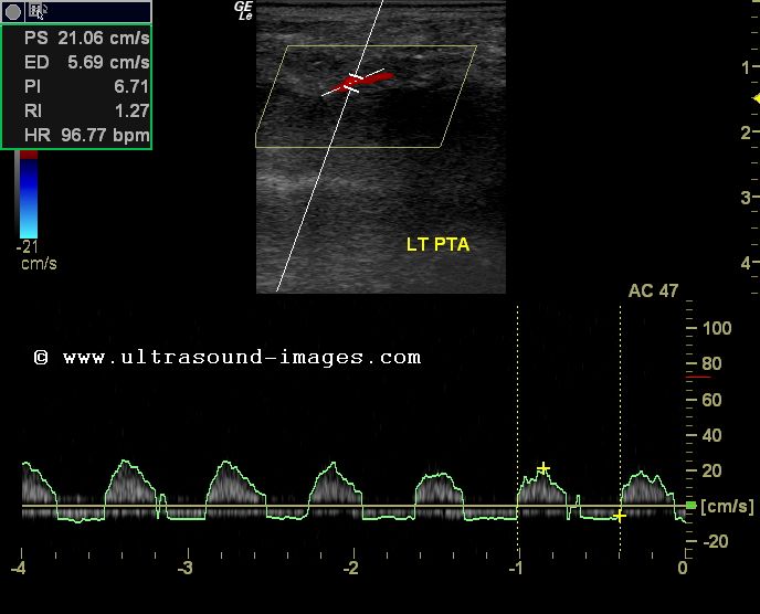 cochinblogs: Doppler study-Severe stenosis of the lower limb arteries
