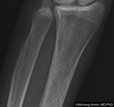 Roentgen Ray Reader: Cortical Tunneling