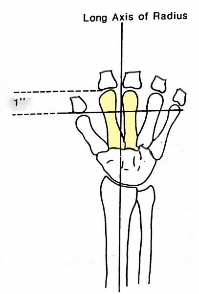 Skeletal Traction: Common sites