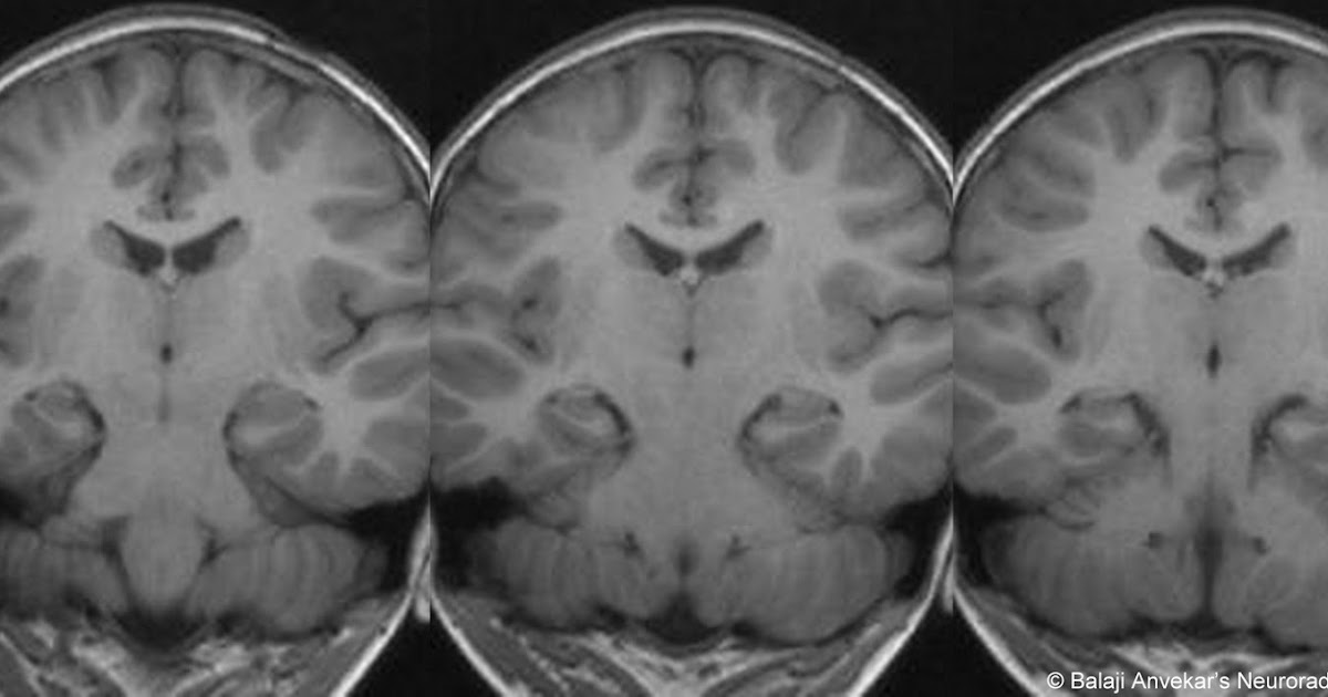 Dr Balaji Anvekar FRCR: Mesial Temporal Sclerosis MRI