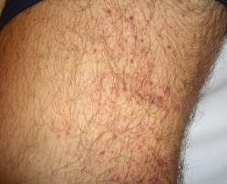 Medical Treatment Pictures-for Better Understanding: Idiopathic ...