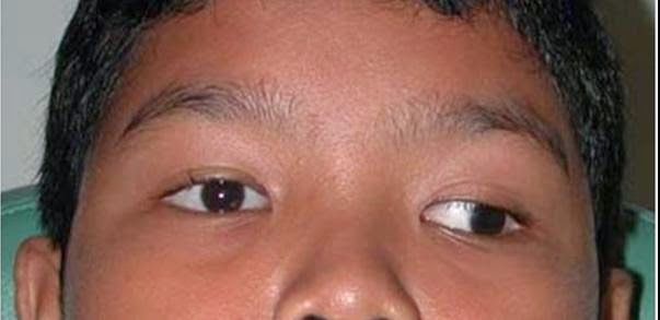 Exotropia Eyes Memes