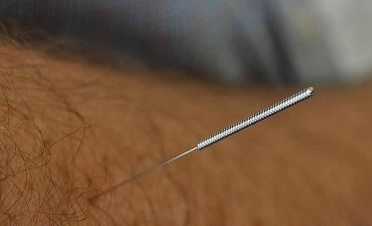 The Therapeutic Resources Blog: As dry needling moves into physical ...