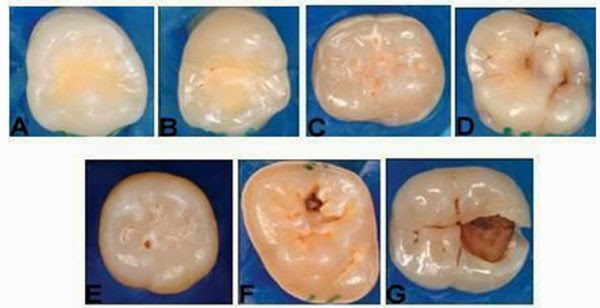 TEJIDOS DENTALES: CLASIFICACIÓN DE LA CARIES