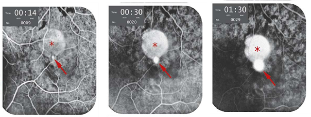 Coriorretinopatía Central Serosa
