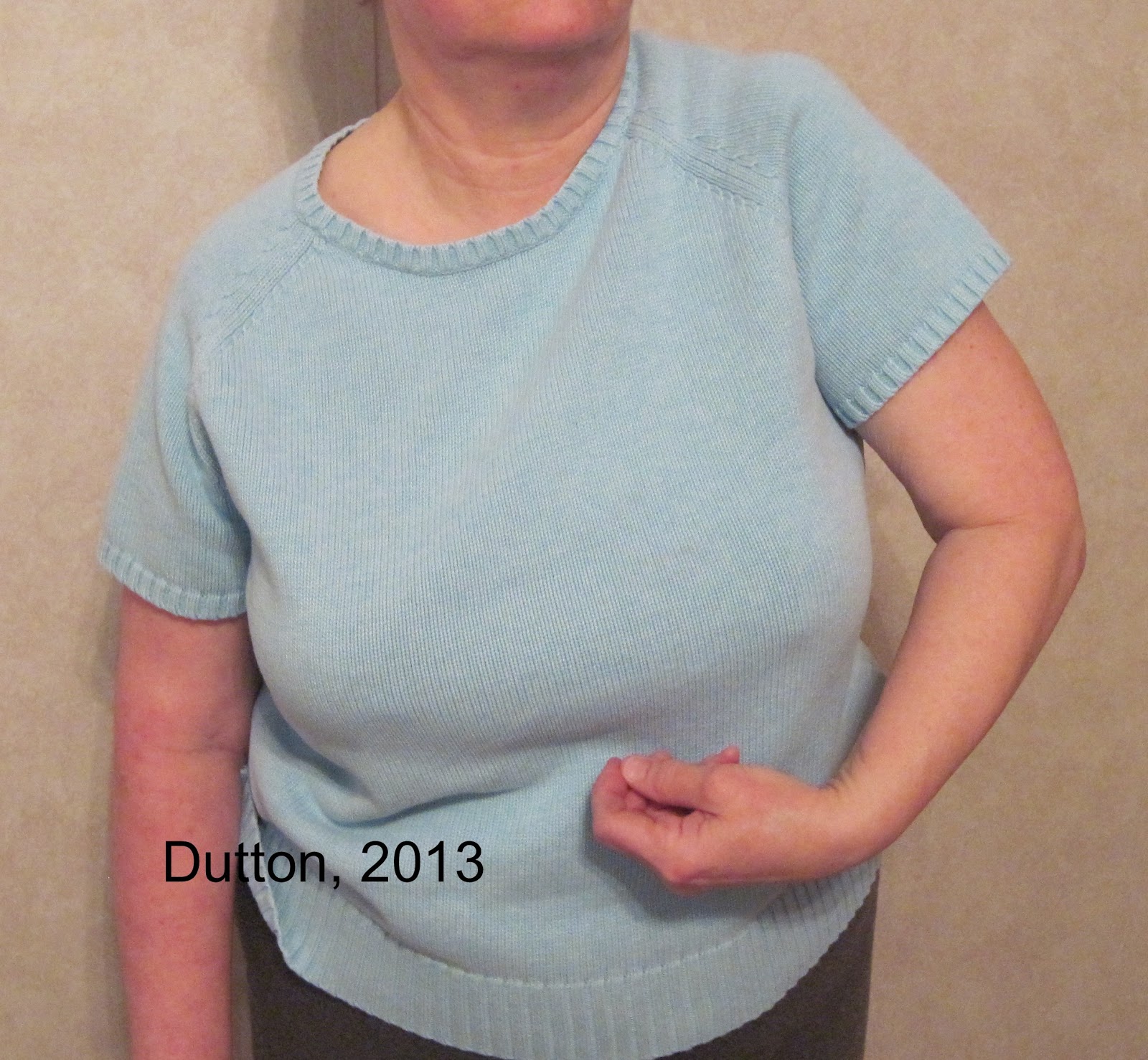 upper limb synergy flexion | Stroke therapy, Stroke rehab, T shirts for ...