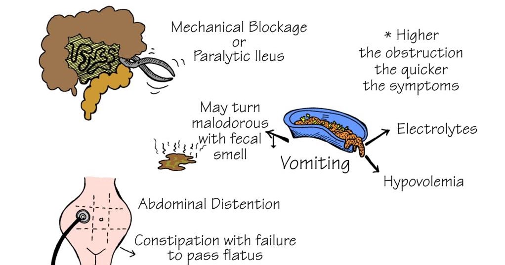 Bowel Obstruction-ABC Medicine
