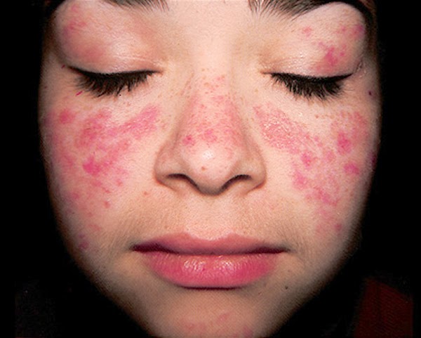 How Diabetes Affects Your Skin....? - COREHEALTH INFO