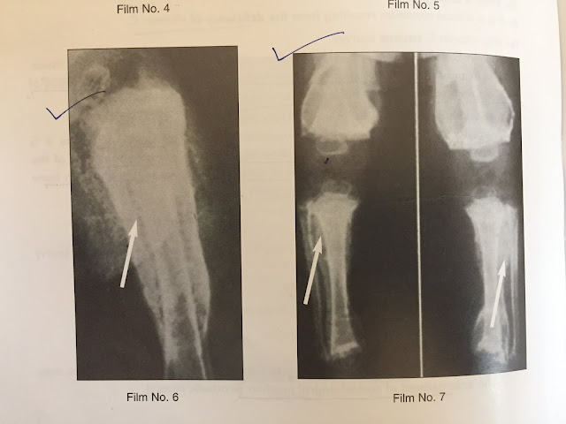 XRAY OF SCURVY DISEASE