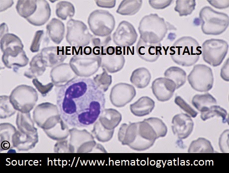 Lab Atlas: Hemoglobin C Crystals