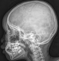 X Ray Cranium Indications soft Tissue Sweling - Radiology Imaging