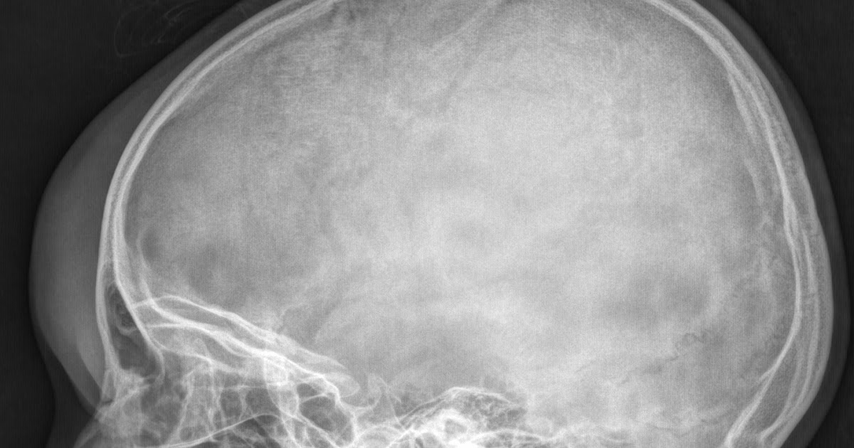 X Ray Cranium Indications soft Tissue Sweling - Radiology Imaging
