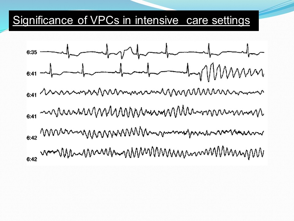 CVT Mohd Farid: Electrocardiogram ECG Part II Common Abnormalities Part I