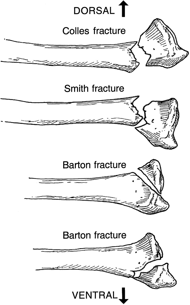 Eponymous fractures of Upper limb