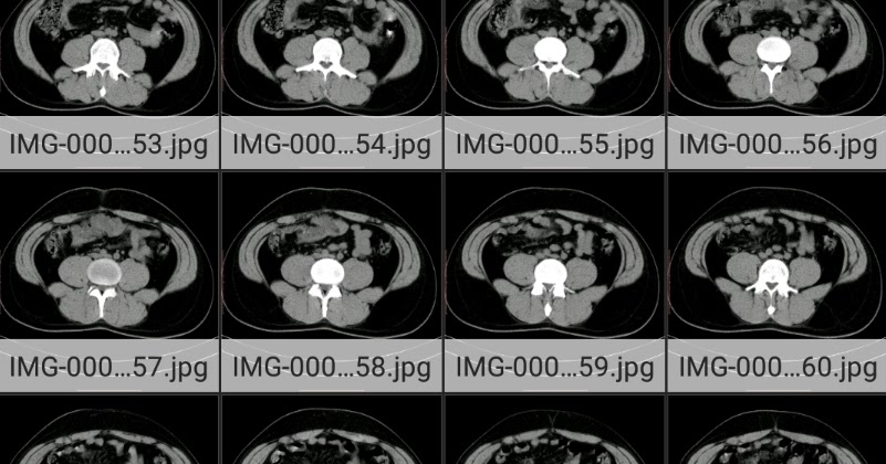 Diagnosis of a CT Urinary Tract, with the report -1