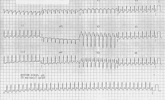 Atrioventricular Reentry Tachycardia | INA - ECG
