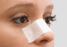 Rhinoplastik: Rhinoplastik Füllstoff