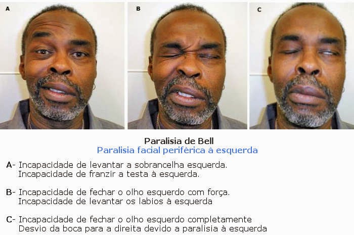 ASSOCIAÇÃO DA GUARDA MUNICIPAL DE ILHÉUS: CONHEÇA A "PARALISIA DE BELL"