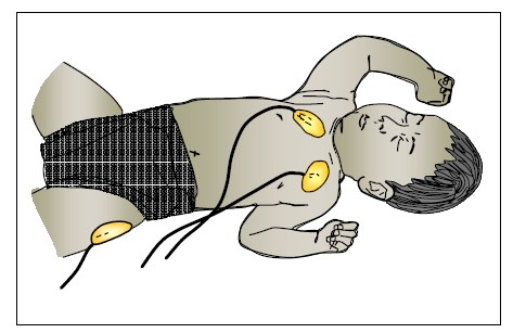 Anestesi Ivan Atjeh: Gangguan Irama Jantung pada Pediatrik