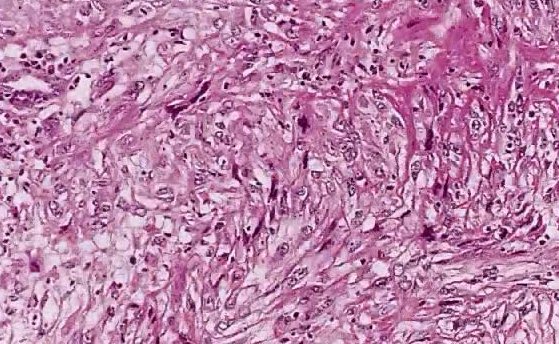 The Definition of Spindle Cell Sarcoma
