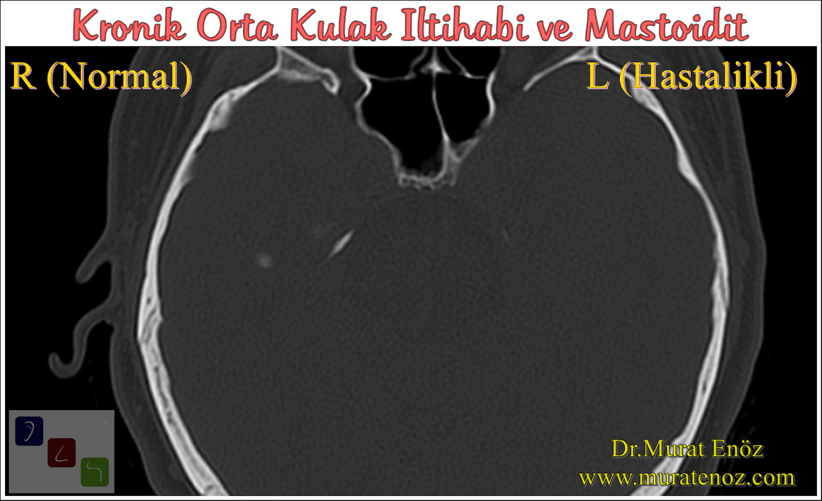 Kronik Orta Kulak İltihabı ve Mastoidit