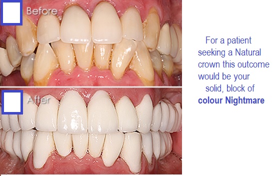 Step by Step Guide to Choosing the Top 3 Criteria to a Natural Dental ...