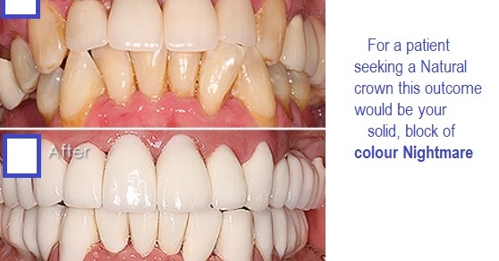 Step by Step Guide to Choosing the Top 3 Criteria to a Natural Dental ...