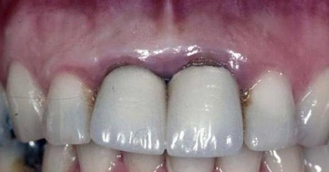 Causes des dents noires - Soins dentaires