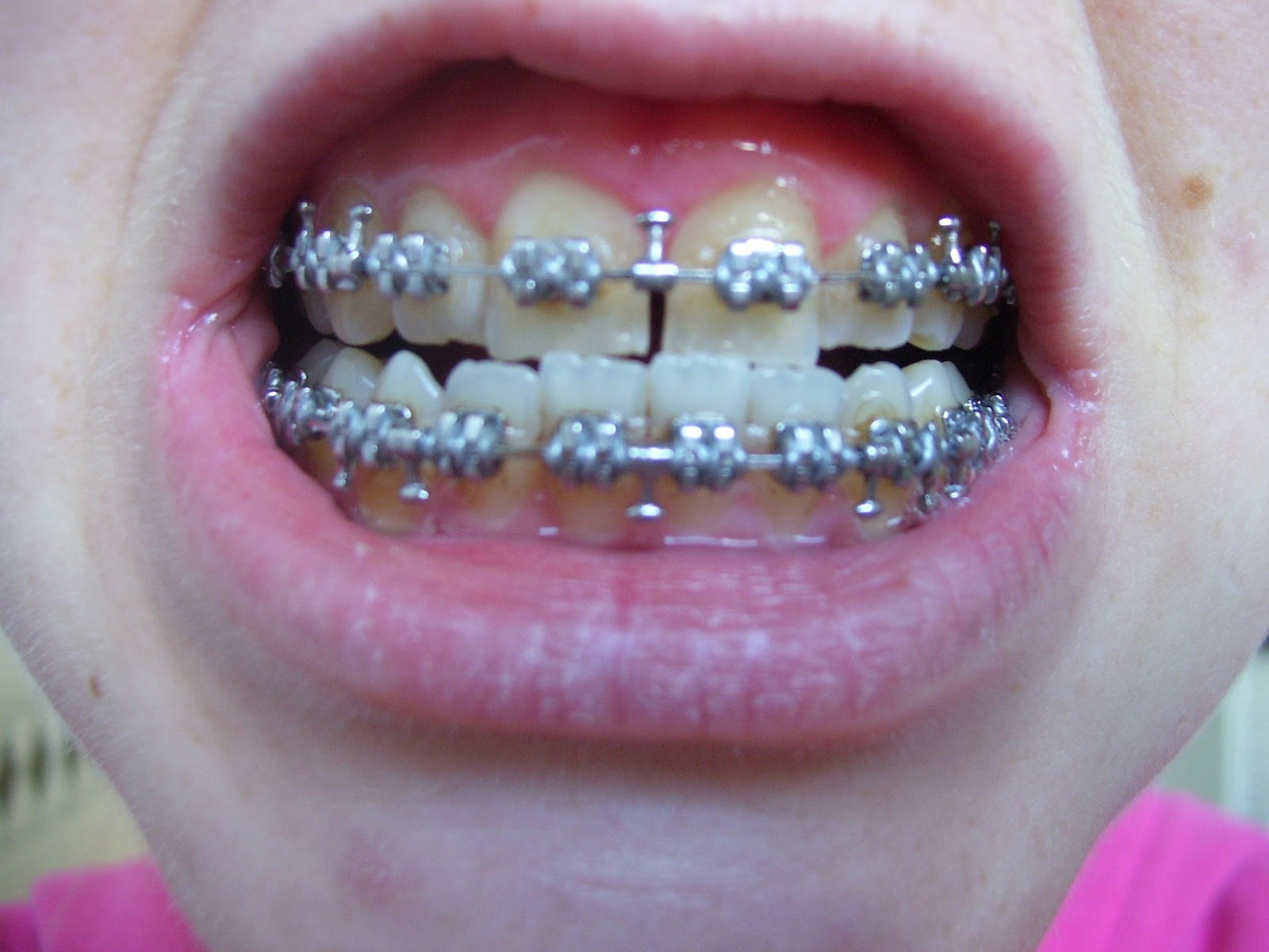 My Jaw Surgery Story: Hygienist appointment and surgical hooks!