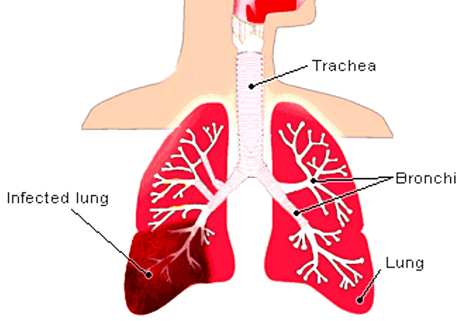 Begini Waspadalah!Kenali Tanda -Tanda Awal Penyakit Radang Paru-Paru