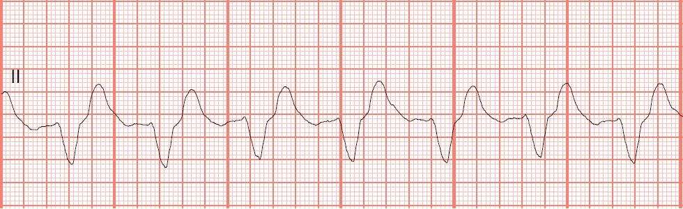 EKG Quiz 329