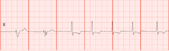 Basic EKG Rhythm Test 46
