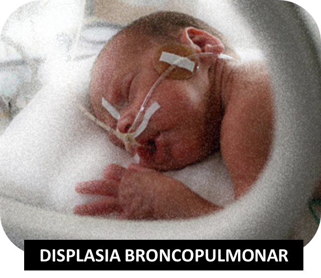Displasia Broncopulmonar